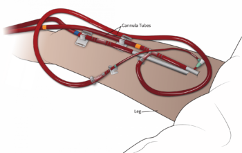 Extracorporeal Membrane Oxygenation (ECMO) | Department of Surgery ...