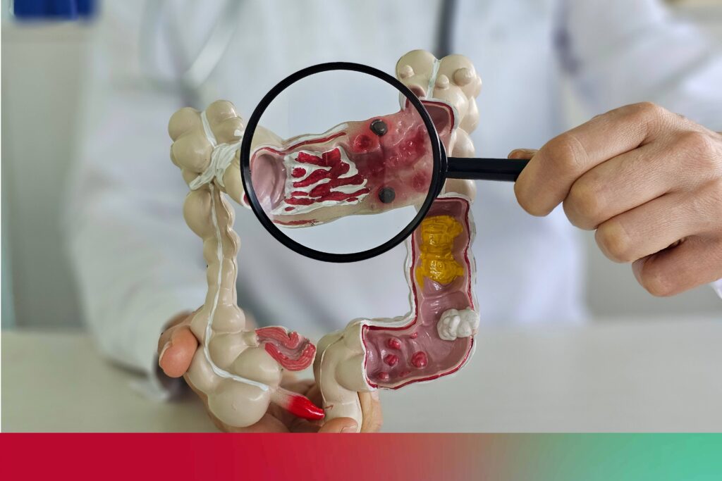 What is colorectal cancer? Signs, symptoms, and risk factors ...